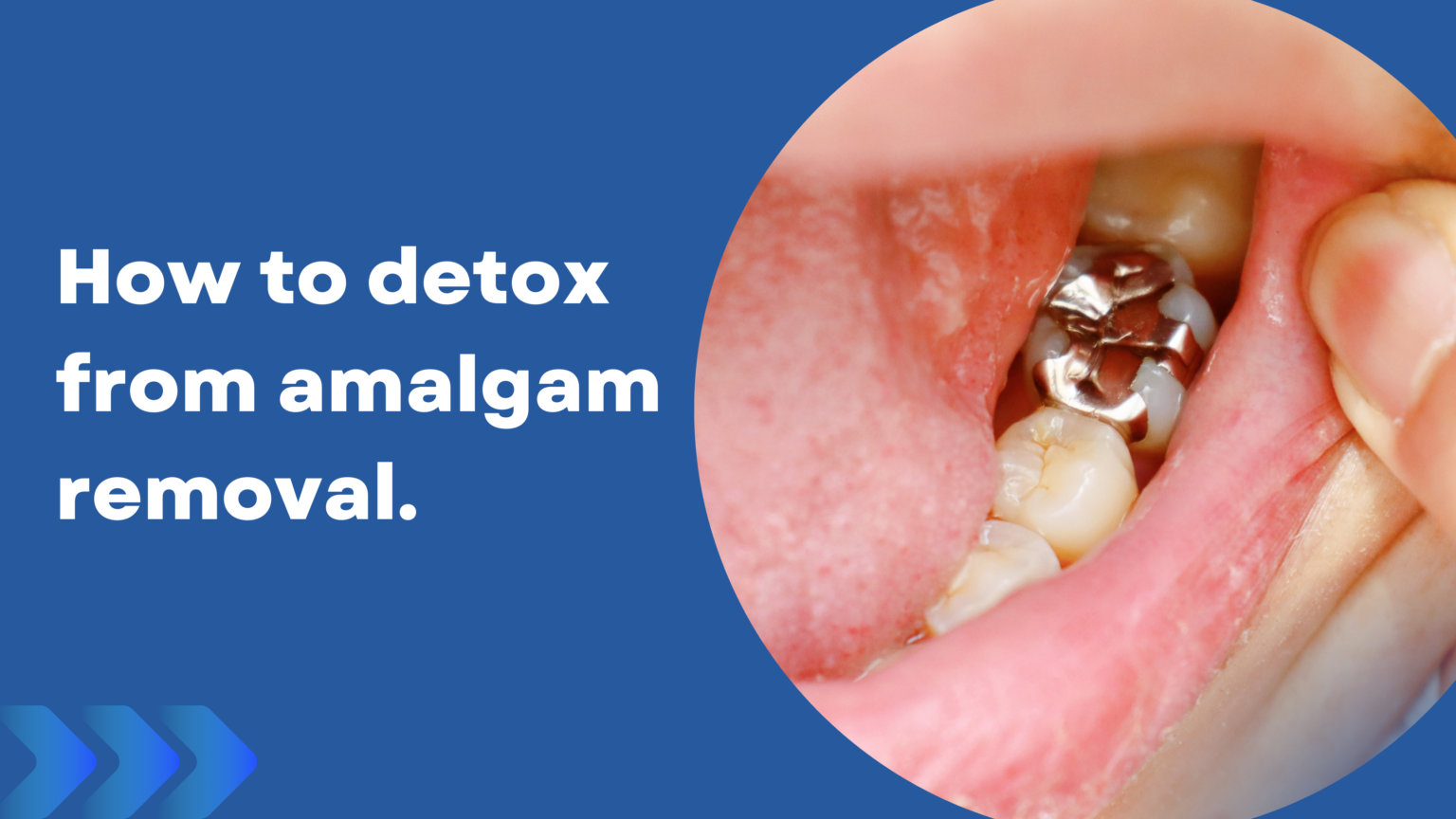 How To Detox From Amalgam Removal - Breast Cancer Conqueror