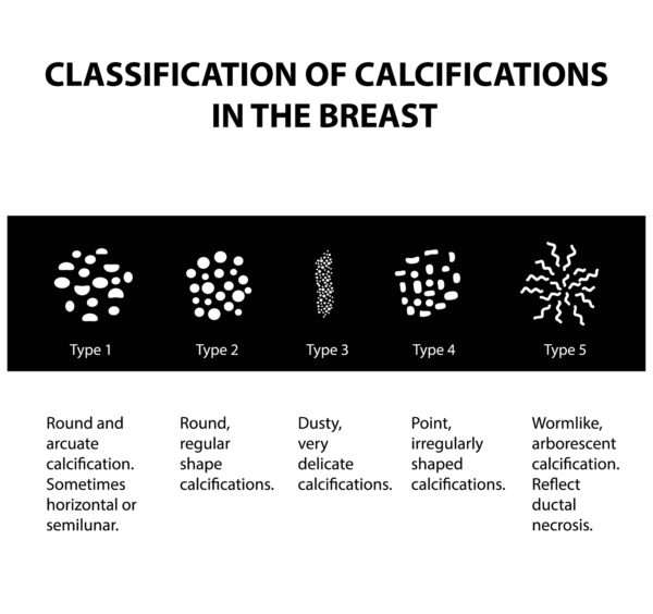 Breast Calcifications: What you should know - Breast Cancer Conqueror